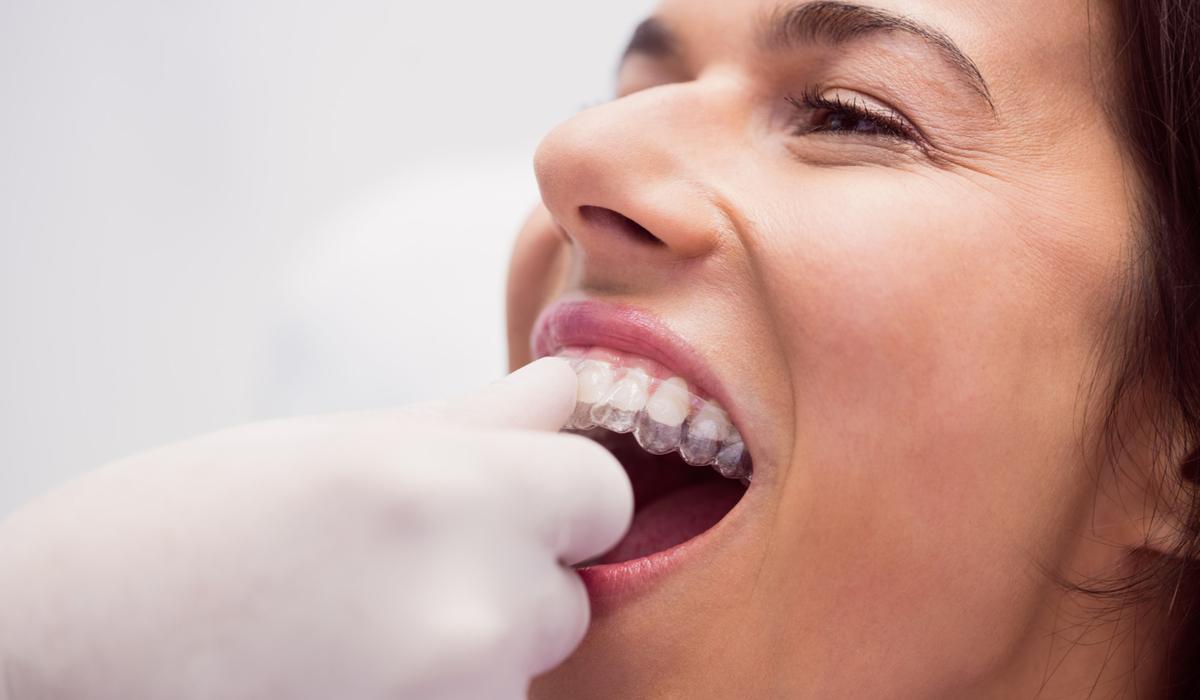 When And Why You Need Invisible Braces