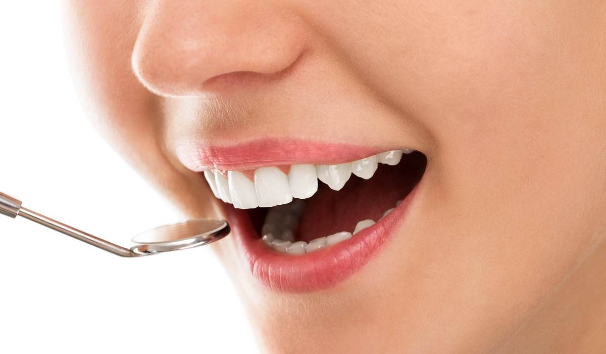 In-House Teeth Whitening or DIY Teeth Whitening